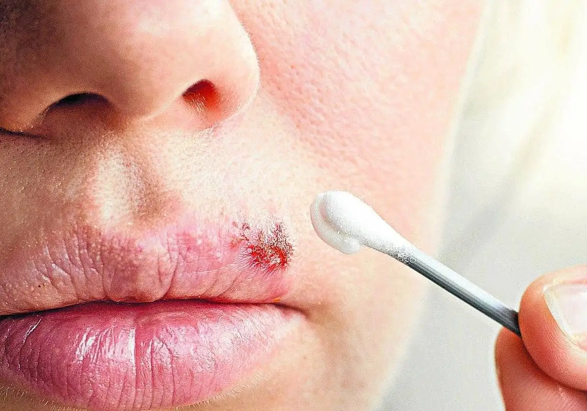 Remedies and Prevention of Cold Sore - Macie Medical